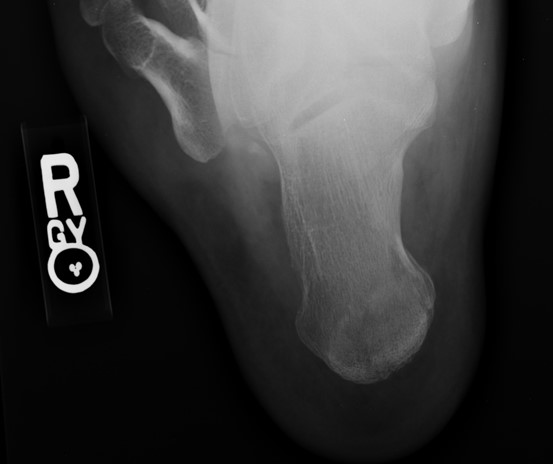 Foot Case 4 Additional Images: Orthopedic Teaching: Feinberg School of ...