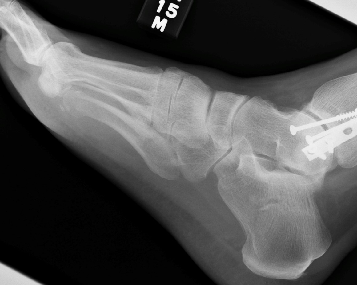 Foot Case 4 Additional Images: Orthopedic Teaching: Feinberg School of ...