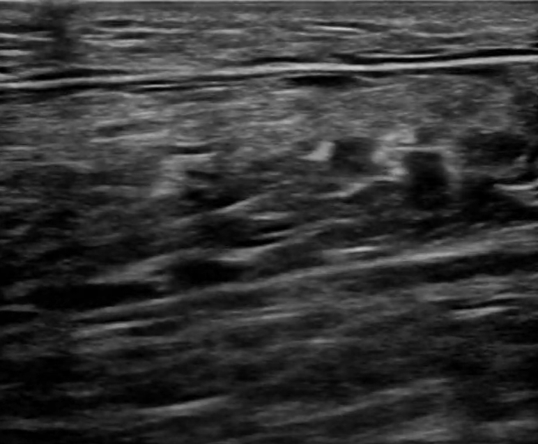 Achilles Tendon Injury: Orthopedic Teaching: Feinberg School of Medicine
