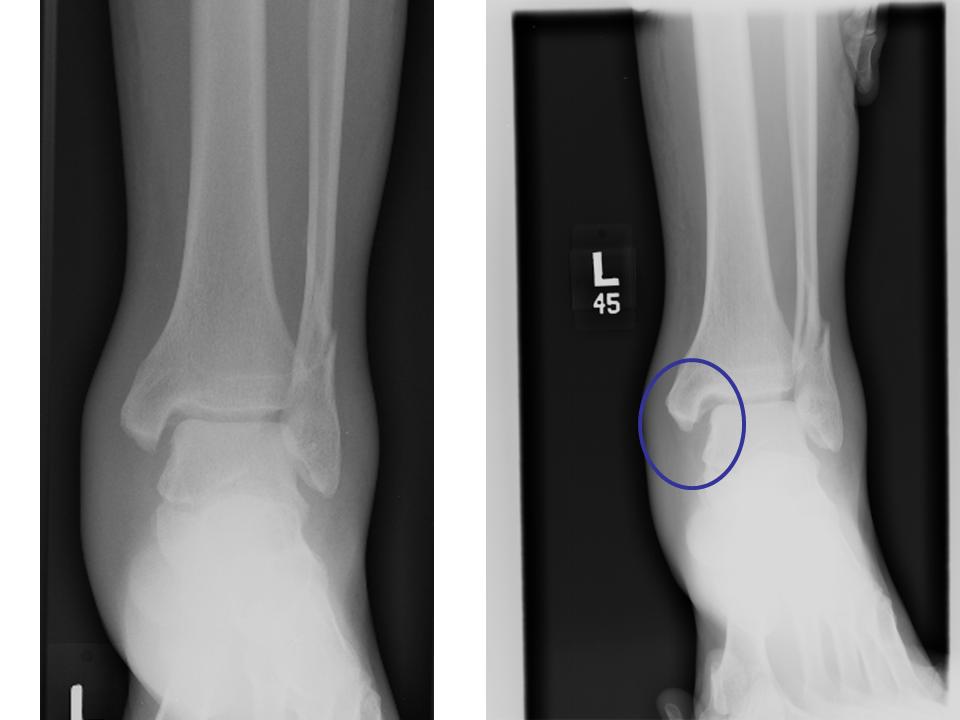 Hairline Fracture Ankle X Ray My XXX Hot Girl Hairline Fracture Ankle X Ray My XXX Hot Girl